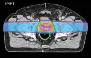 Seed implant v. IMRT v. Protons v. Cyberknife (SBRT) - Texas Prostate ...